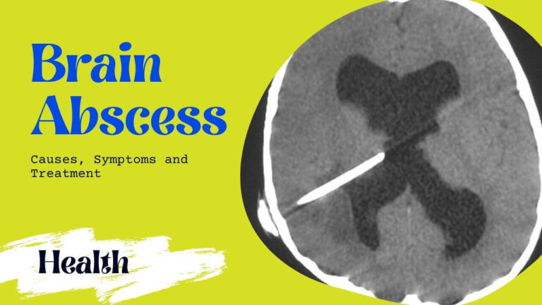 Brain Abscess: Causes, Symptoms And Treatment [Full] » 2025