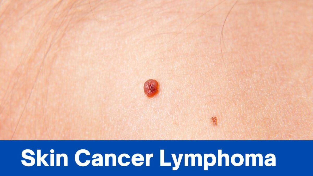 Defeating Skin Cancer Lymphoma: Your Ultimate Guide To Triumph » 2026